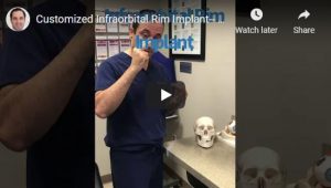 Customized Infraorbital Rim Implant Beverly Hills | Tear Trough Implant