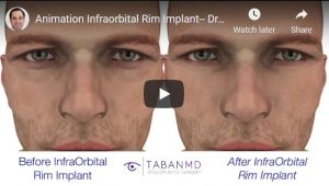 Customized Infraorbital Rim Implant Beverly Hills | Tear Trough Implant