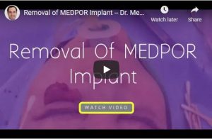 Customized Infraorbital Rim Implant Beverly Hills | Tear Trough Implant