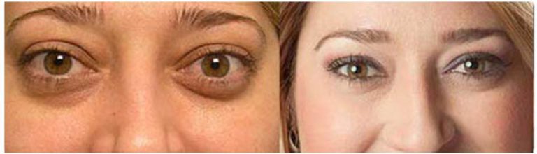 Orbital Decompression Surgery Beverly Hills - Bulgy Eye Surgery | Taban