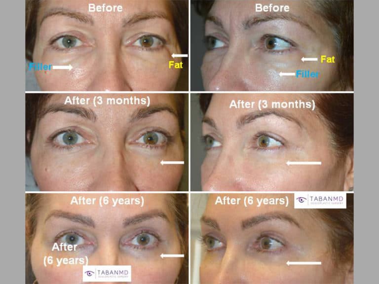 Lower Blepharoplasty Beverly Hills | Under Eye Bag | Dark Circle