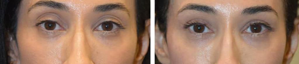 Upper Blepharoplasty Beverly Hills | Eyelid Lift Los Angeles
