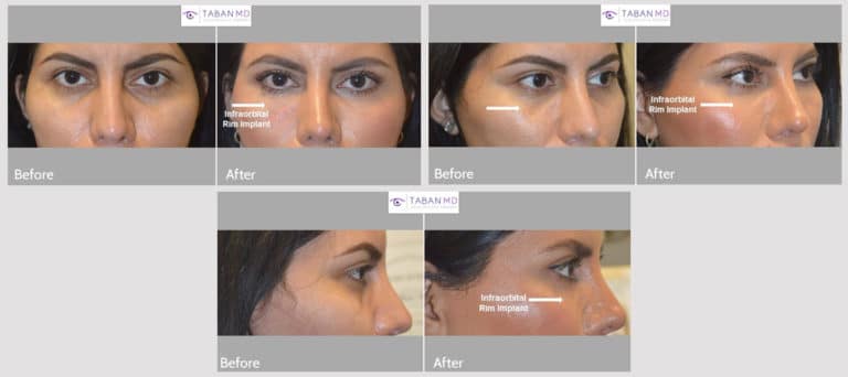 Customized Infraorbital Rim Implant Beverly Hills | Tear Trough Implant