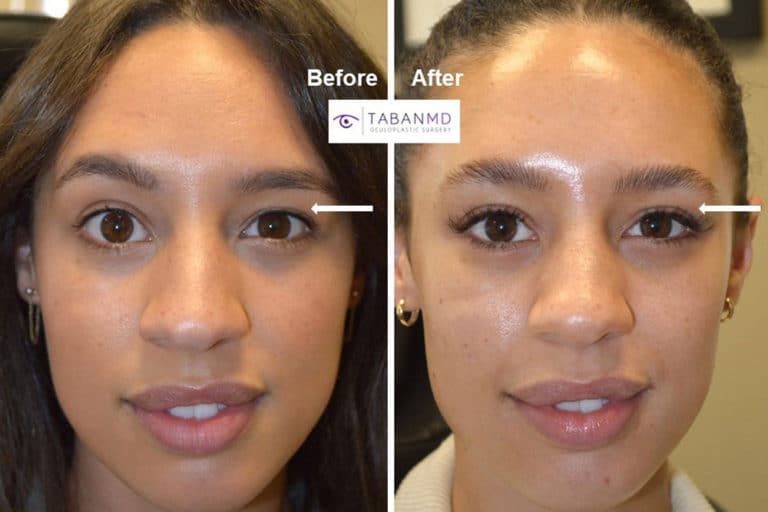 Eye Asymmetry Surgery and Treatment | Fix Uneven Eyes