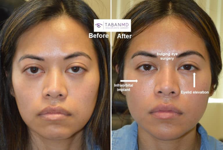 What is Eye Shape Change? Dr. Taban MD | Beverly Hills, Ca