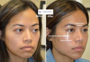 What is Eye Shape Change? Dr. Taban MD | Beverly Hills, Ca