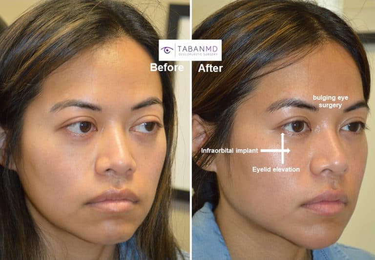 What is Eye Shape Change? Dr. Taban MD | Beverly Hills, Ca
