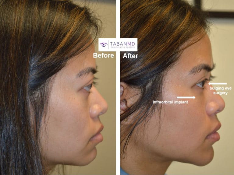 What is Eye Shape Change? Dr. Taban MD | Beverly Hills, Ca